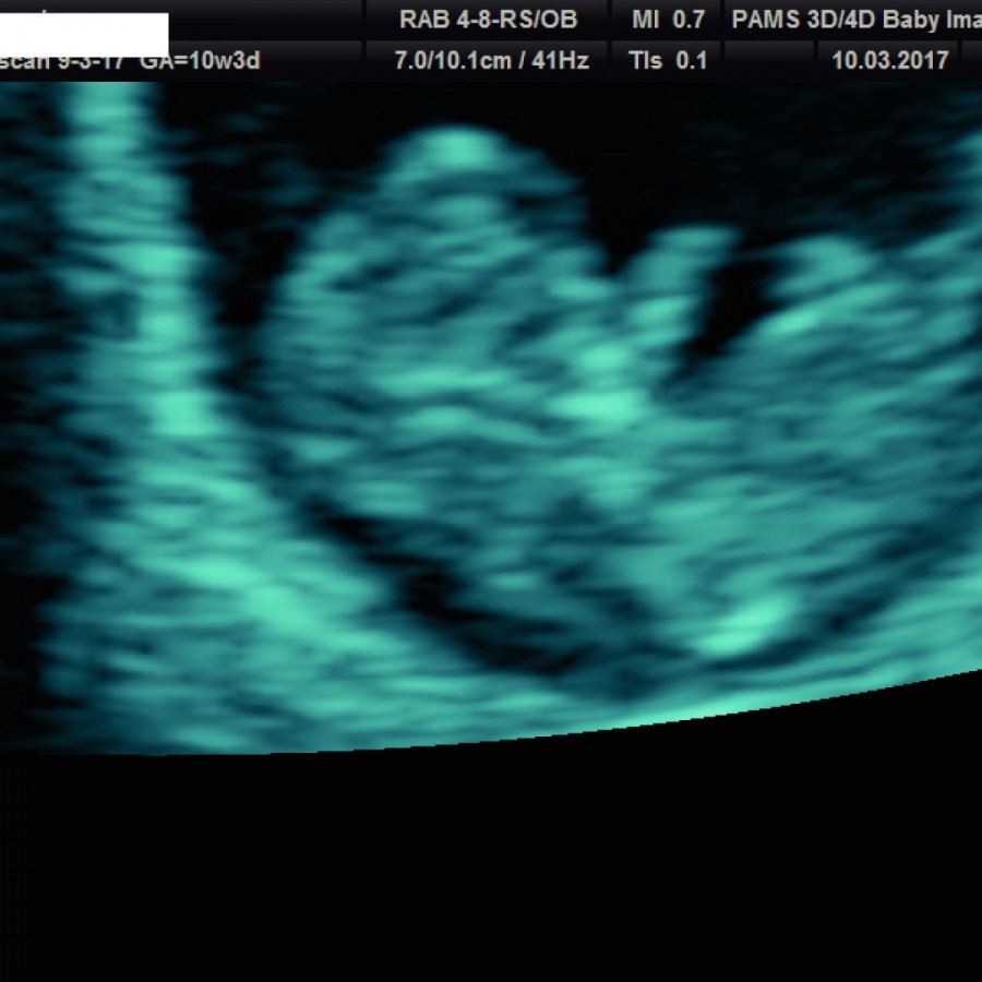 Early Pregnancy Scan | Private One-On-One Pregnancy & Fertility ...