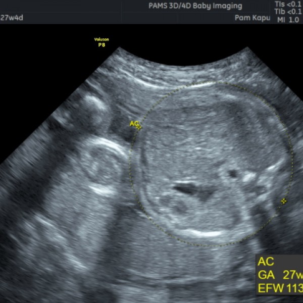 Baby Growth Scan | Private One-On-One Pregnancy & Fertility Ultrasound ...