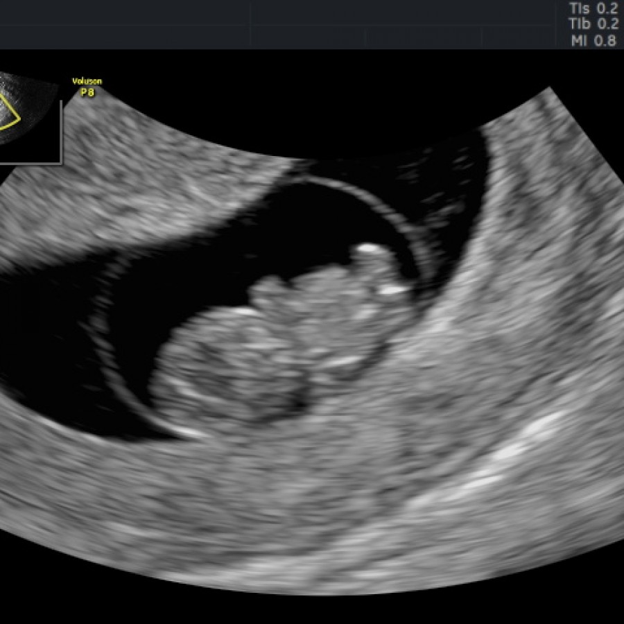 Early Pregnancy Scan | Private One-On-One Pregnancy & Fertility ...