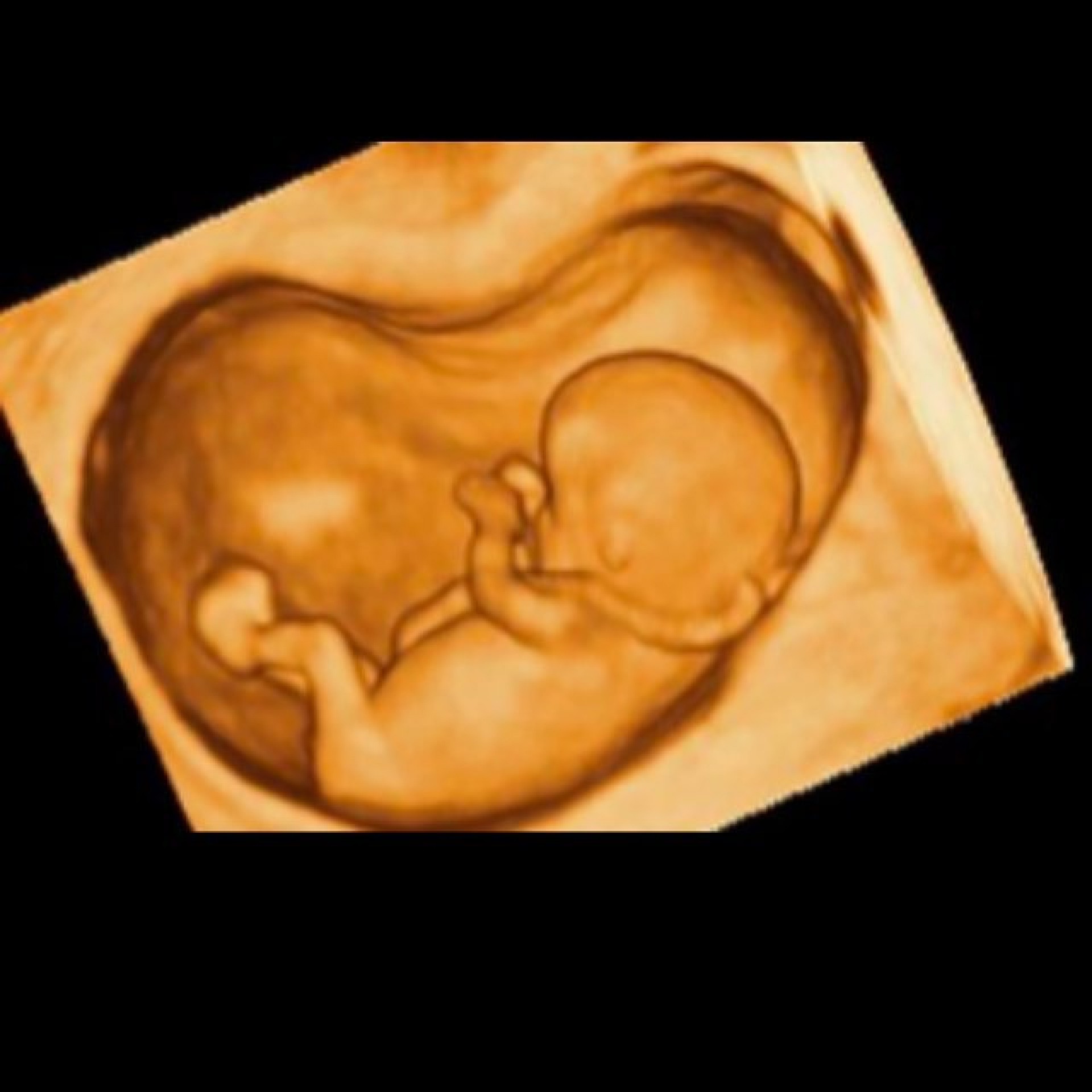 Early Pregnancy Scan | Private One-On-One Pregnancy & Fertility ...