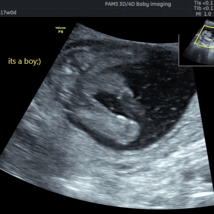 Gender Reveal Scan | Private One-On-One Pregnancy & Fertility ...