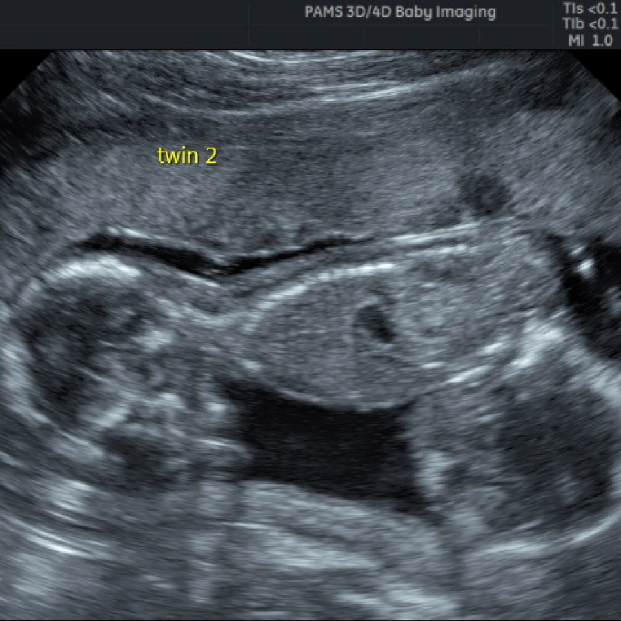 Baby Growth Scan | Private One-On-One Pregnancy & Fertility Ultrasound ...