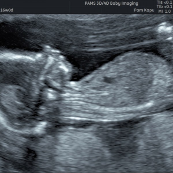 Gender Reveal Scan | Private One-On-One Pregnancy & Fertility ...