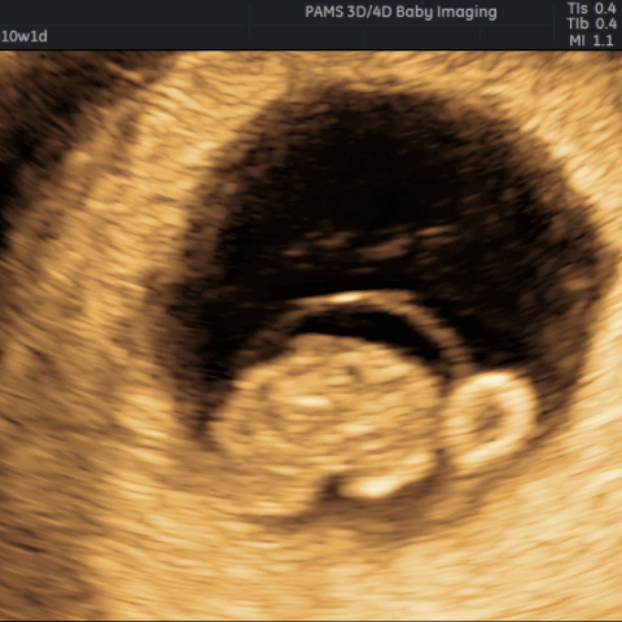 Early Pregnancy Scan | Private One-On-One Pregnancy & Fertility ...