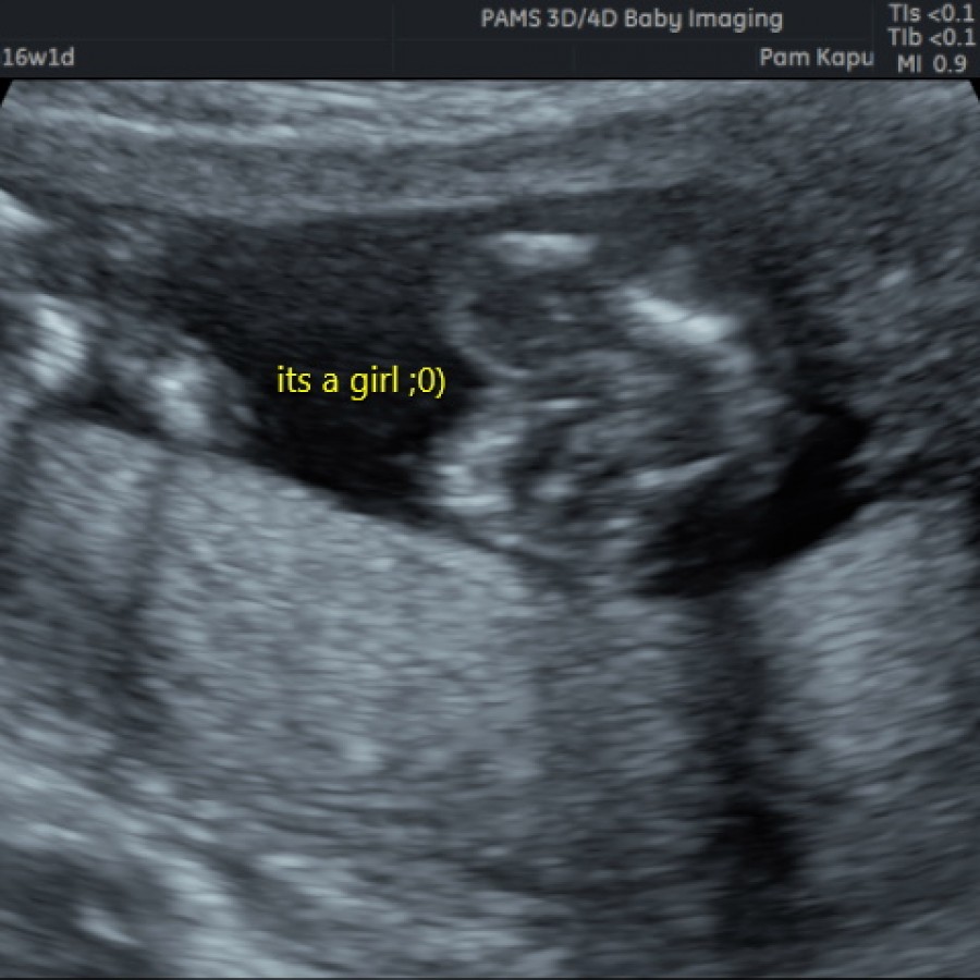 Gender Reveal Scan | Private One-On-One Pregnancy & Fertility ...