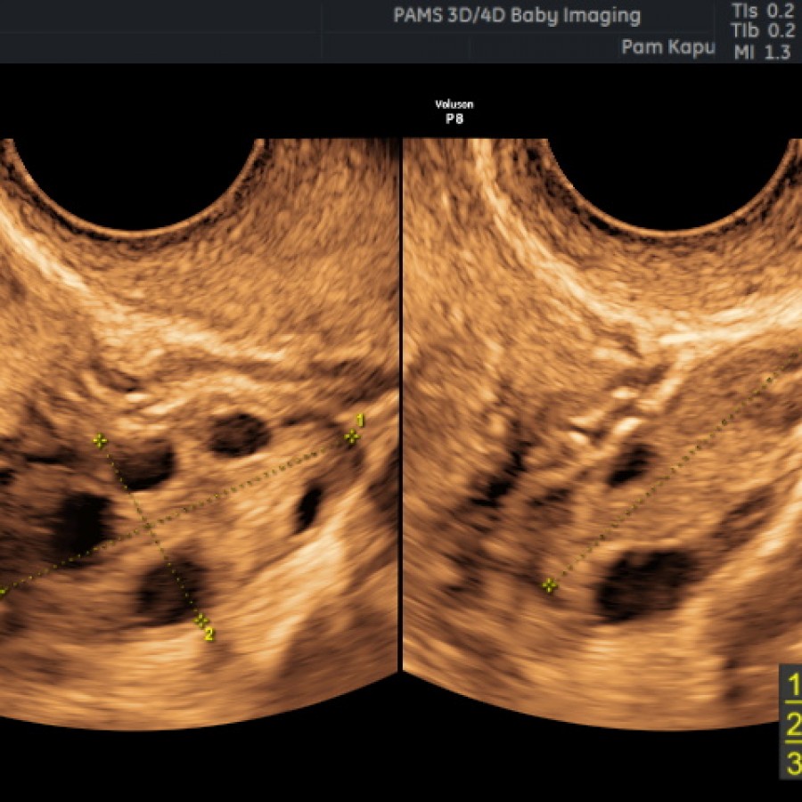 Gynaecological Pelvic Scan | Private One-On-One Pregnancy & Fertility ...