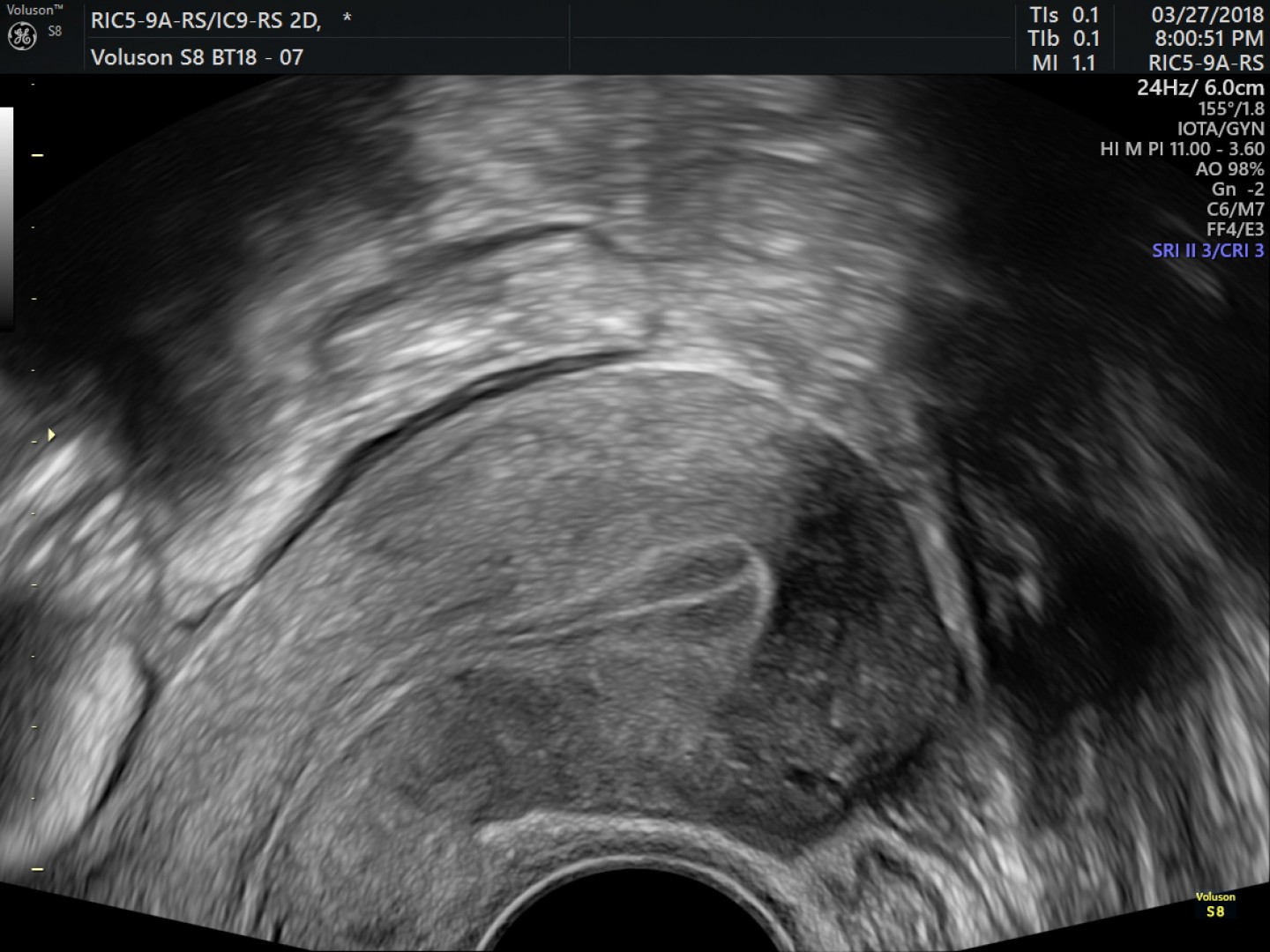 Fertility Scan | Private One-On-One Pregnancy & Fertility Ultrasound ...